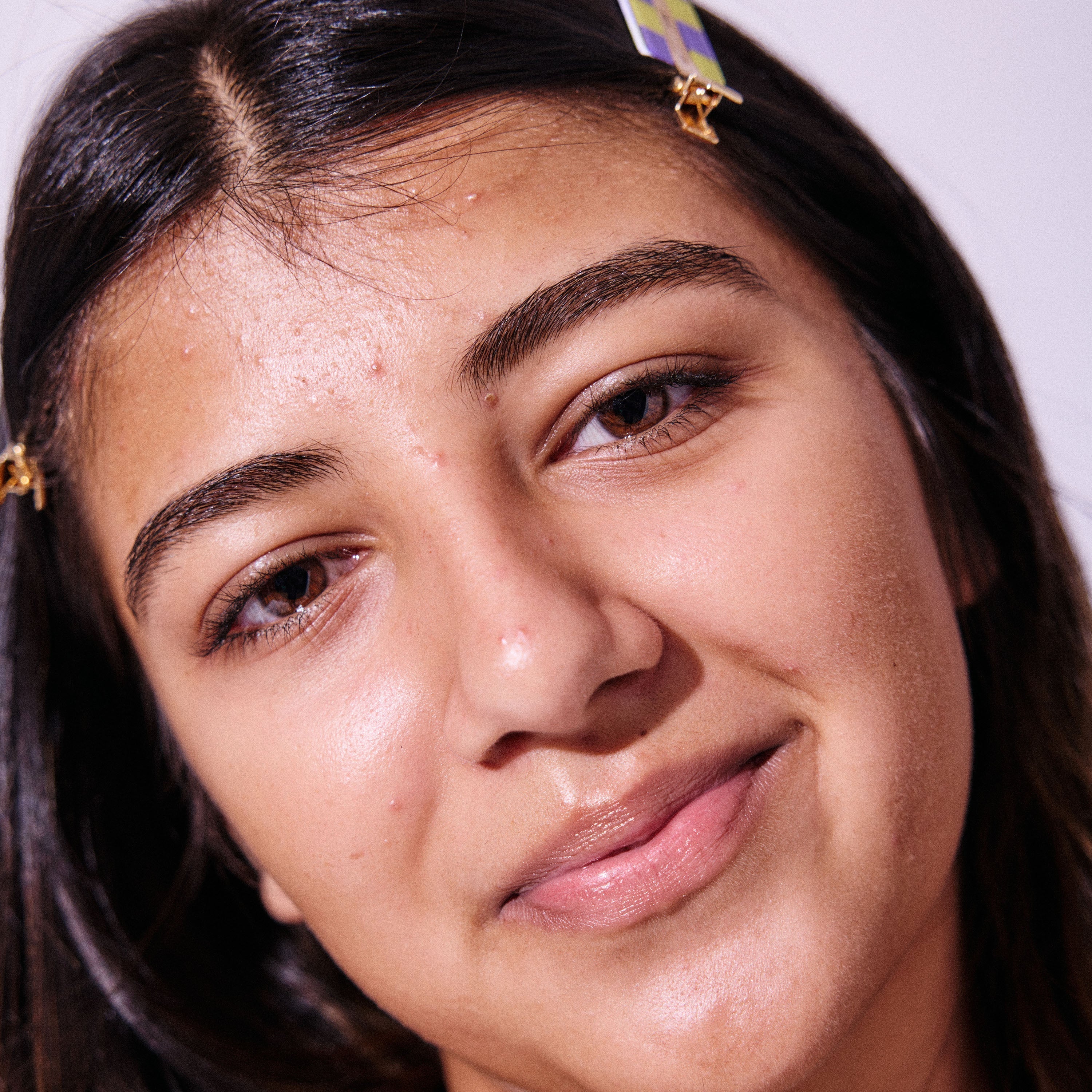 What is congested skin? – indu Beauty